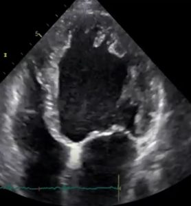 Non-Compaction-Kardiomyopathie – Cardioplaner